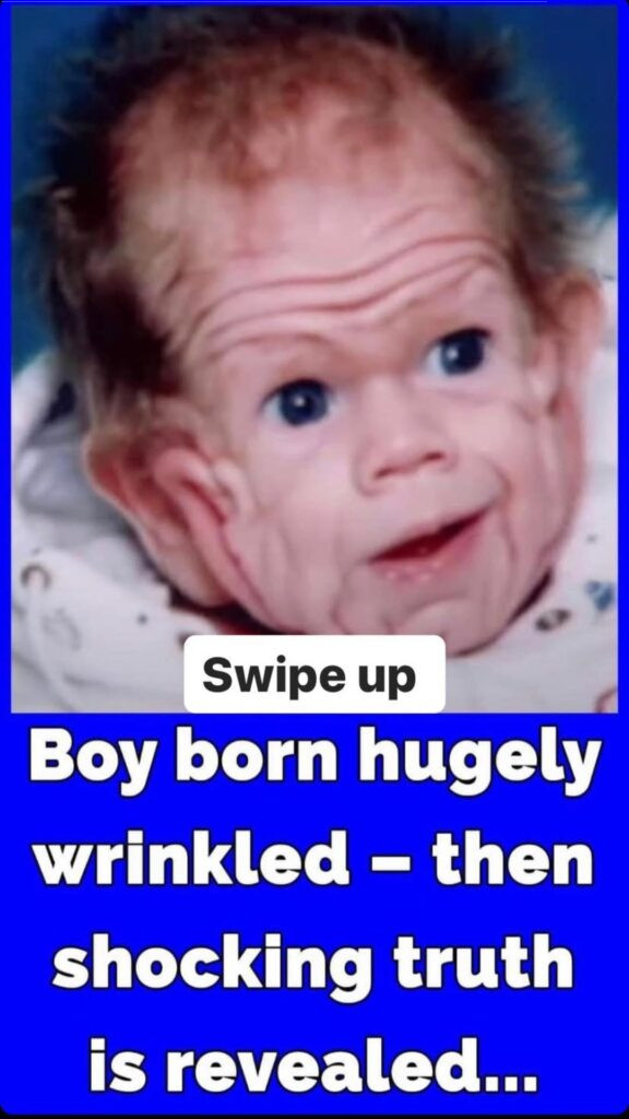 Tomm Tennent: The unique baby born with enough skin to cover the body ...