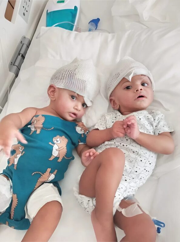 From Conjoined to Independent: The Remarkable Journey of Sisters Manal ...